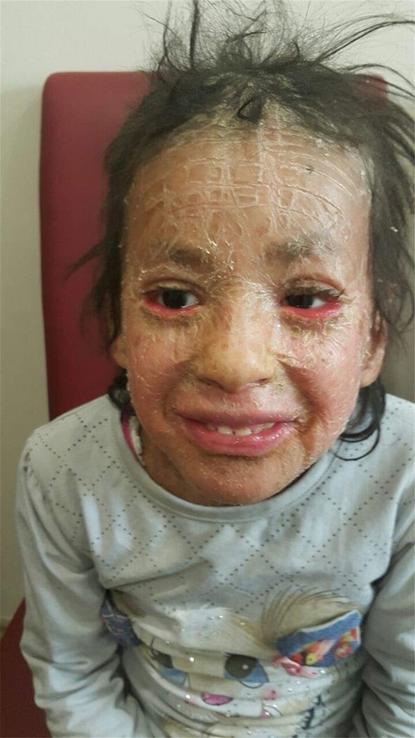Küçük kızın derisi balık pulu gibi dökülüyor - Yeni Akit