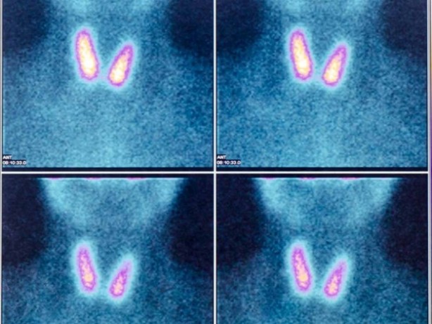 Tiroid nedir, tiroid hastalığının belirtileri nelerdir? - Yeni Akit