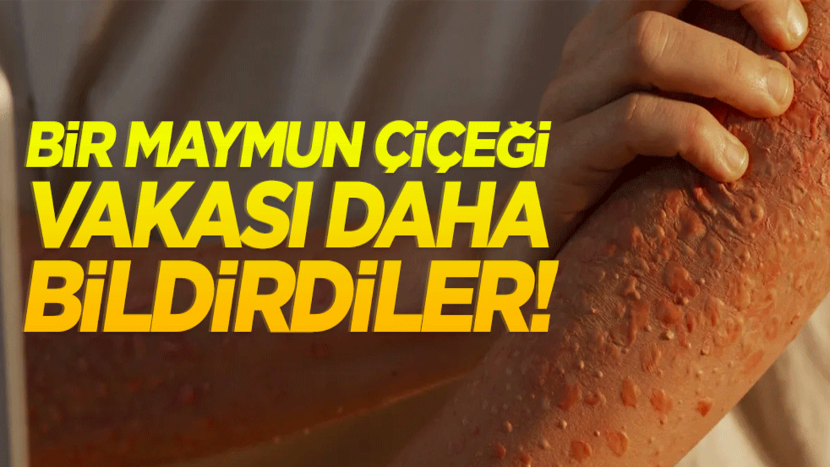 Bir maymun çiçeği vakası daha bildirdiler! - Yeni Akit