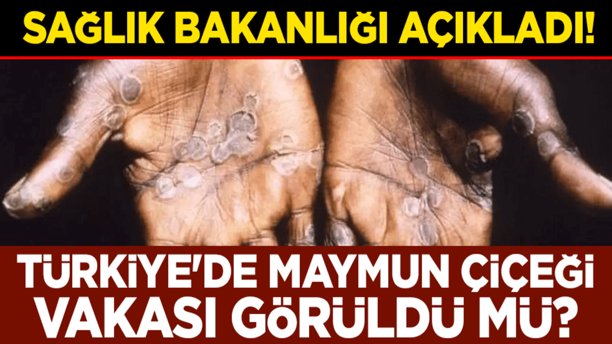 Sağlık Bakanlığı açıkladı! Türkiye'de maymun çiçeği vakası görüldü mü ...